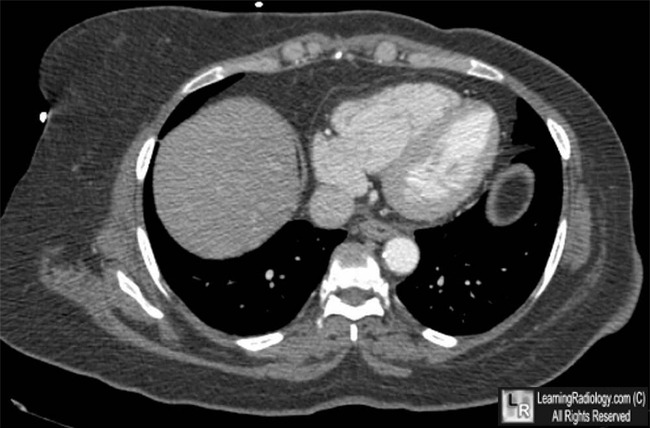 LearningRadiology - Epicardial, Pericardial Fat, Pad