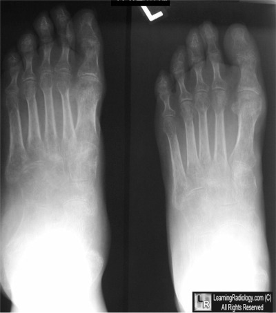 LearningRadiology - Complex, Regional, Pain, Syndrome, CRPS, Reflex ...