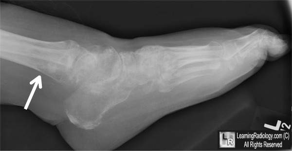LearningRadiology - Complex, Regional, Pain, Syndrome, CRPS, Reflex ...