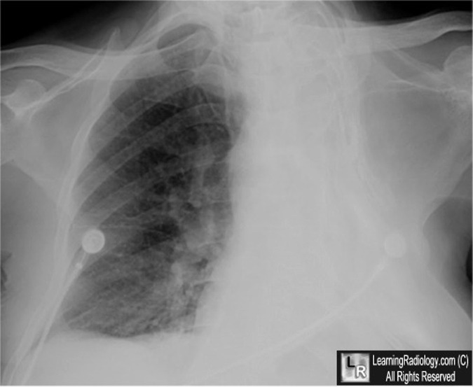 LearningRadiology - Thoracoplasty, tb, ribs, thorax, wall, thoracic ...