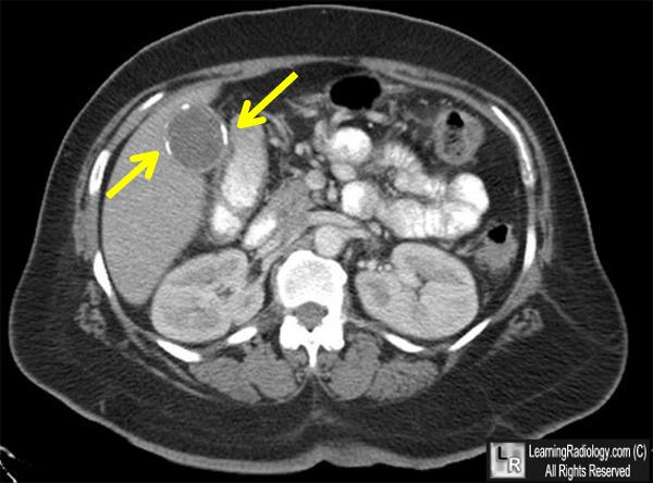 LearningRadiology - Porcelain Gallbladder, carcinoma, gb