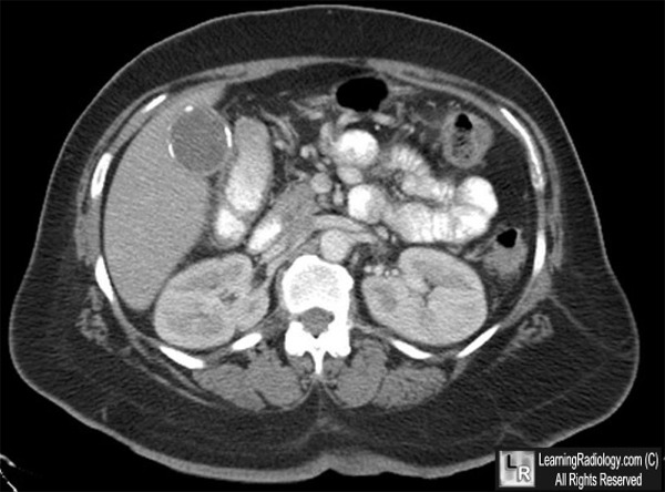 LearningRadiology - Porcelain, Gallbladder, gb, chronic, cholecystitis ...