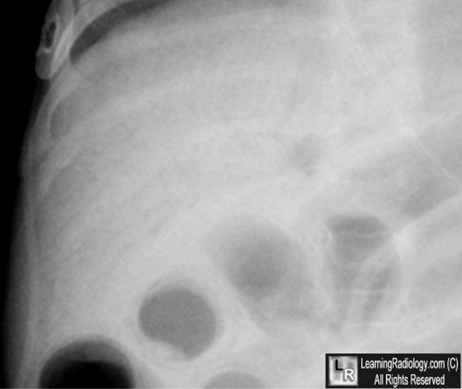 LearningRadiology - necrotizing, enterocolitis, nec