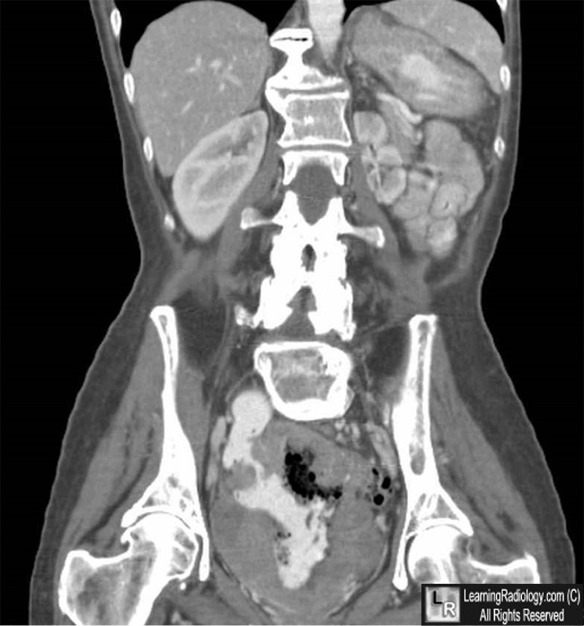 LearningRadiology - lymphoma, small, bowel