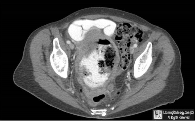 LearningRadiology - lymphoma, small, bowel