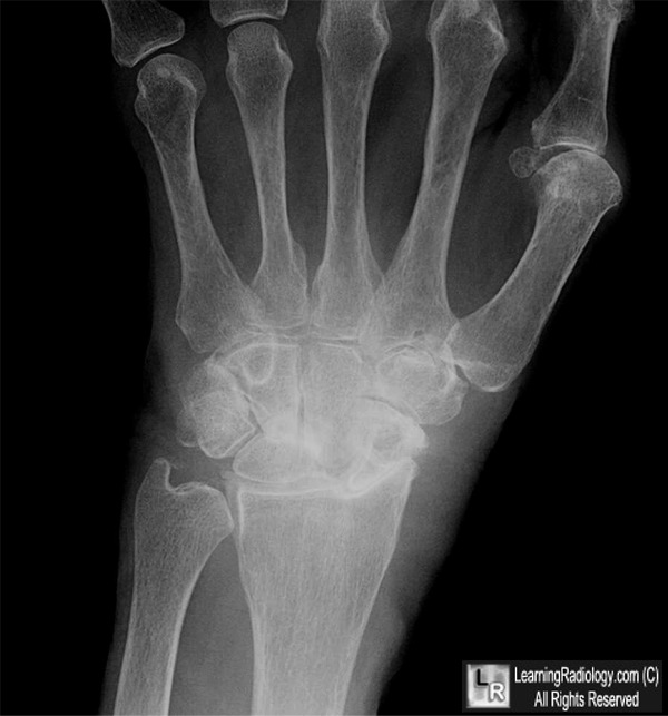 LearningRadiology - Calcium, Pyrophosphate, Deposition, Disease, cppd