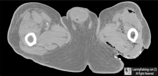 LearningRadiology - Necrotizing, Fasciitis, gas, air, strep, gas ...