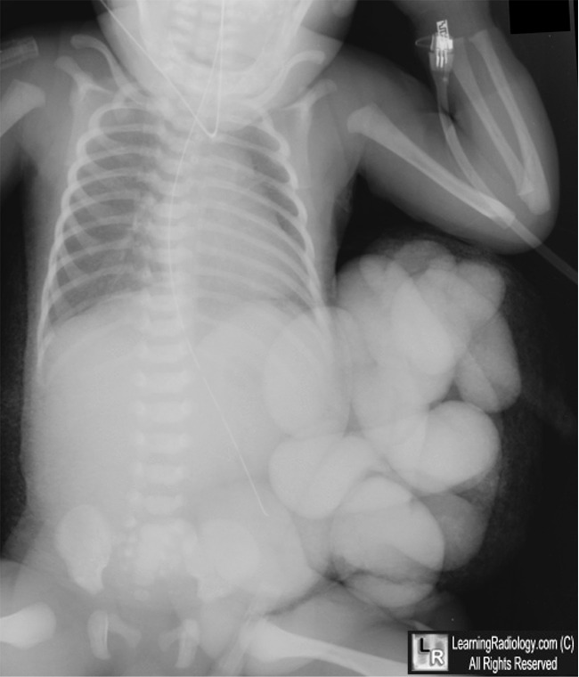 LearningRadiology - Gastroschisis, omphalocele, omphalocoele, radiology