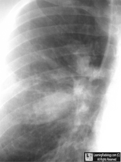 LearningRadiology - ABPA, Mucoid, Impaction, aspergillosis, allergic ...