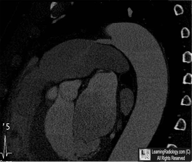 LearningRadiology - patent, ductus, arteriosus, pda, left, right shunt ...