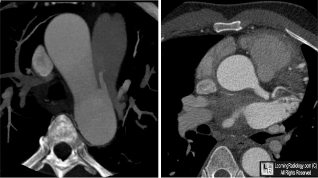 LearningRadiology - patent, ductus, arteriosus, pda, left, right shunt ...
