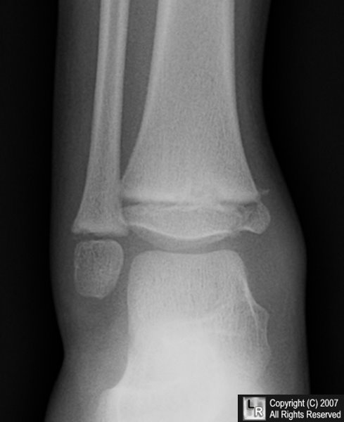 LearningRadiology - Salter-Harris, Epiphyseal, Fractures, type, 4, IV ...
