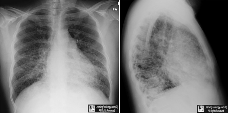 LearningRadiology - PCP, Pneumocystis, Carinii, Pneumonia, Jerovecii ...