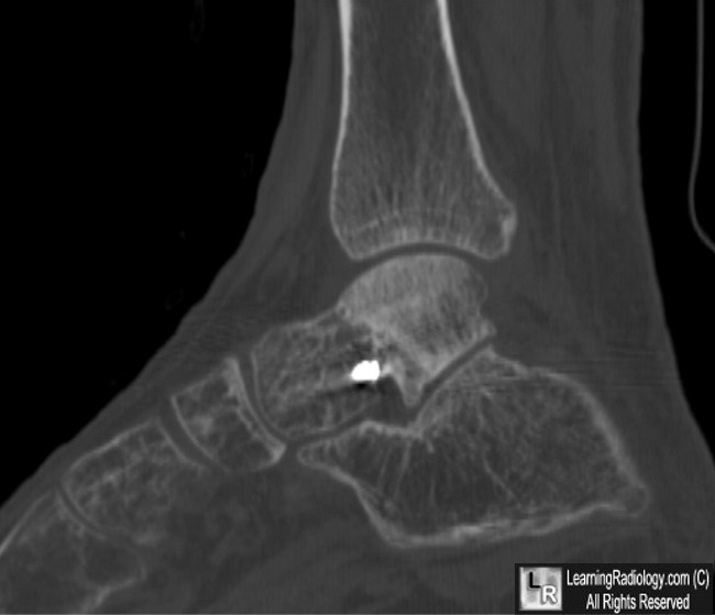 LearningRadiology - Avascular Necrosis, Talus, avn, post-traumatic ...