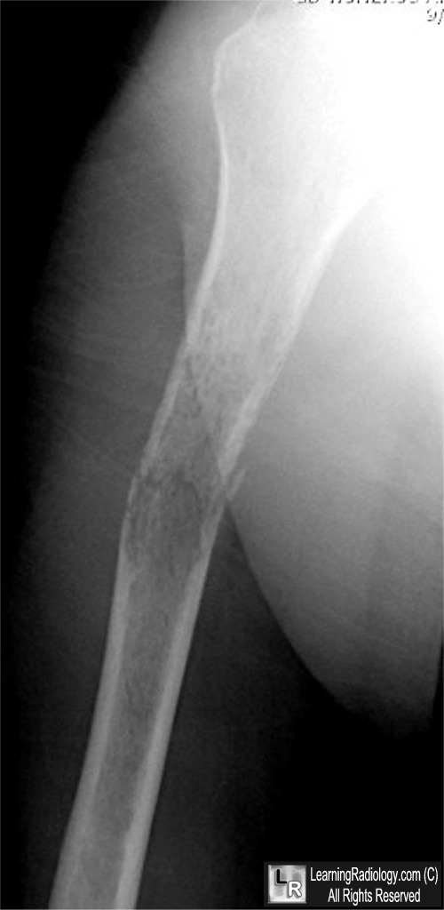 LearningRadiology - Pathologic, Fracture, pathological, malignancy ...