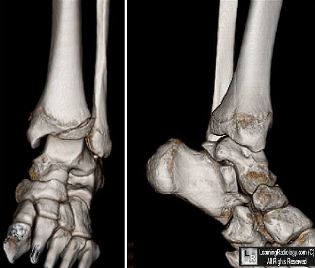 LearningRadiology - Triplane, Fracture, tibia, tillaux, distal, ankle ...