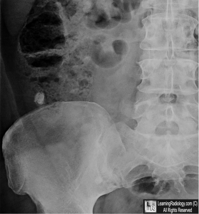 LearningRadiology - Appendicolith, Appendicitis
