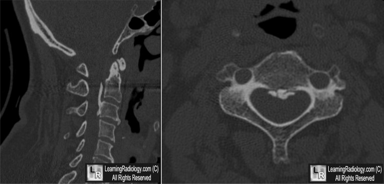 LearningRadiology - Ossification, Posterior, Longitudinal, Ligament ...
