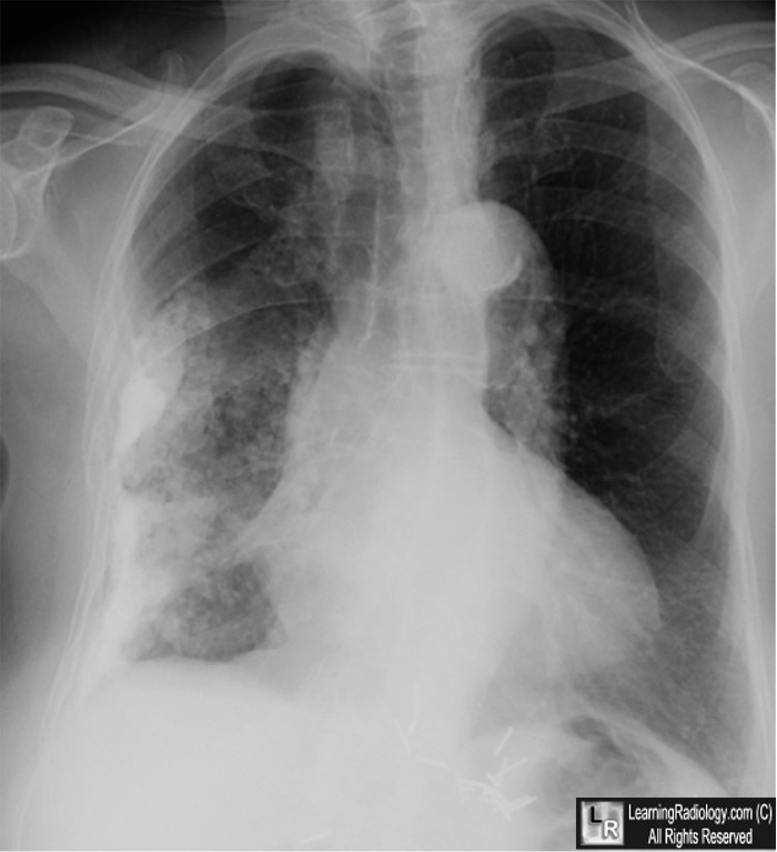 LearningRadiology - Tuberculous, Empyema, tb, tuberculosis, chest ...