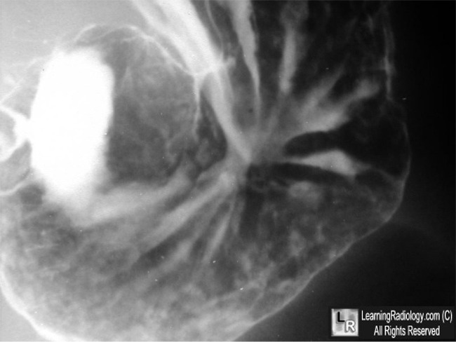 LearningRadiology - Gastric Ulcer