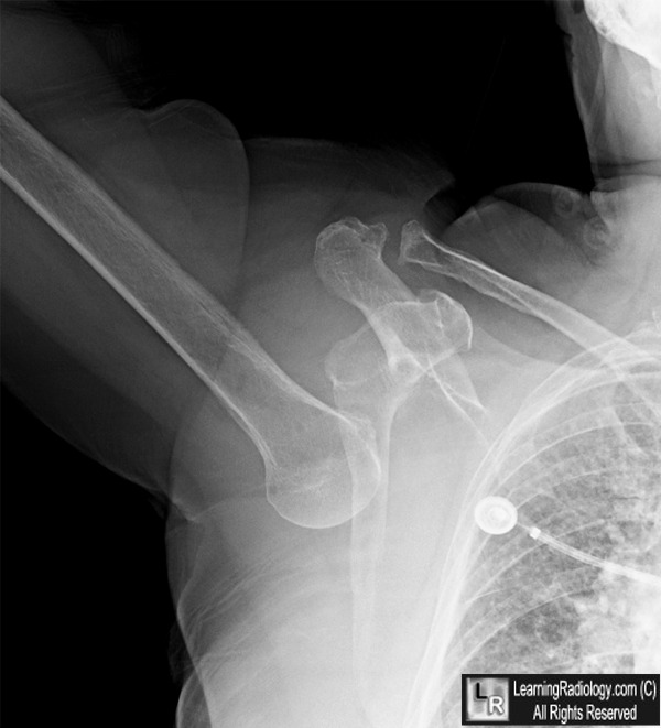 LearningRadiology - Luxatio erecta, inferior, shoulder, dislocation