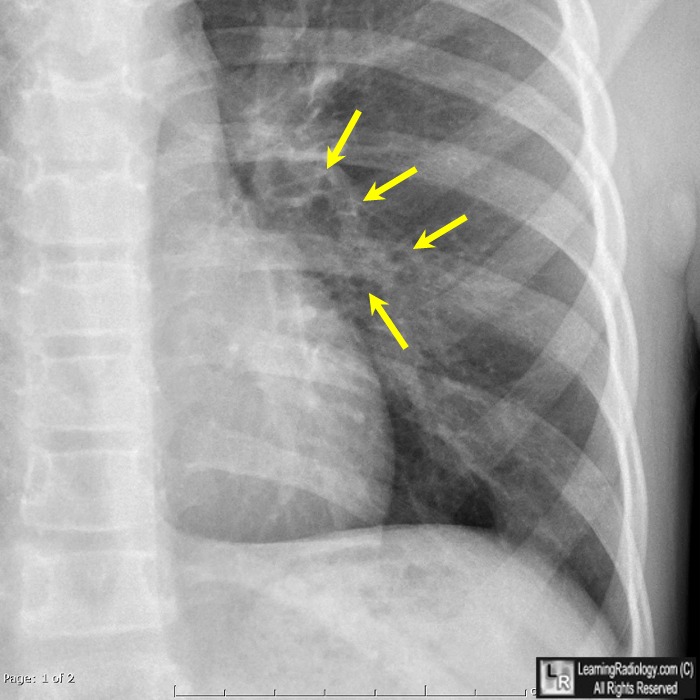 Chest X Ray Showing Acute Bronchitis at Darrel Ferreira blog