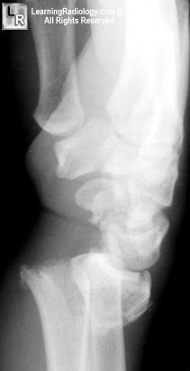 Learning Radiology - Four Fractures of the Wrist, Rolando, Bennett ...