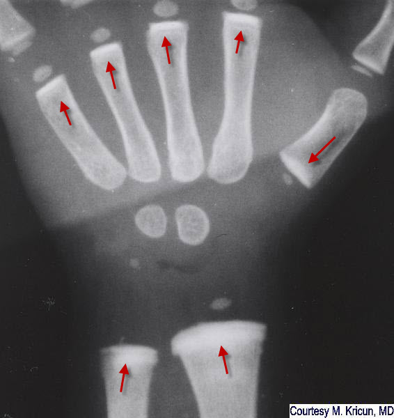 Learning Radiology - Lead, poisoning, plumbism, intoxication, ingestion ...