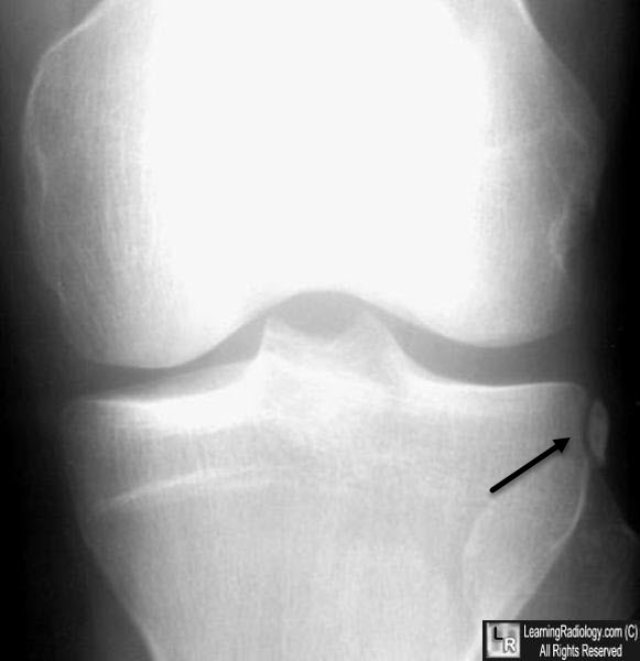 Learning Radiology - Segond Fracture
