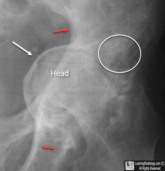 LearningRadiology - acetabular, protrusio, acetabuli, paget, hip, radiology