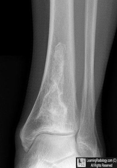 Learning Radiology - Bone Infarct, Medullary Bone Infarct, Osteonecrosis