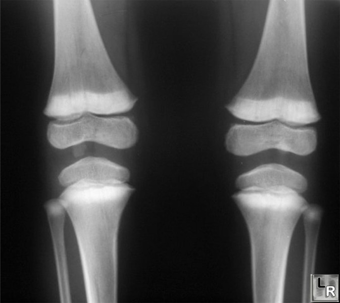 Learning Radiology - Lead, poisoning, plumbism, intoxication, ingestion ...