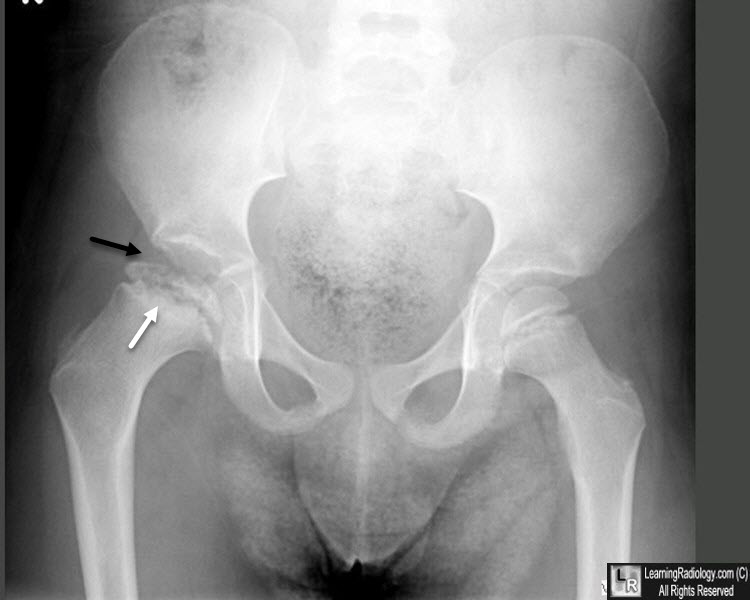 LearningRadiology Legg Calve Perthes