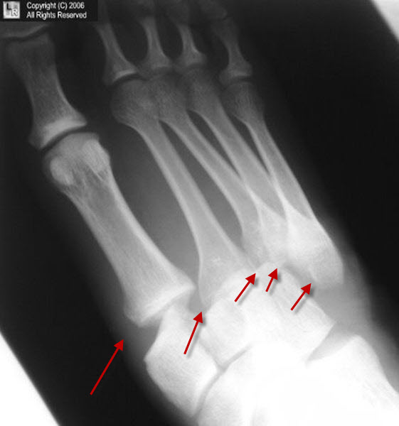 Learning Radiology - lisfranc, fracture, dislocation