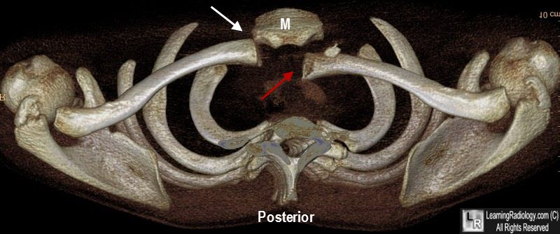 Learning Radiology - Posterior Strernoclavicular Dislocation