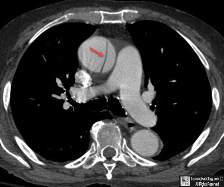 LearningRadiology - Aortic Dissection, Aorta