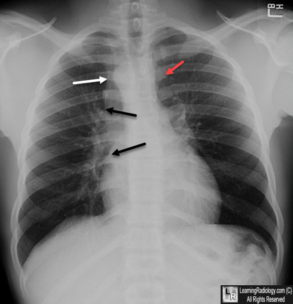 Learning Radiology - Right Aortic Arch, anomalies, mirror image
