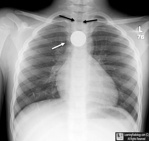 LearningRadiology - Coin, FB, foreign, body, esophagus