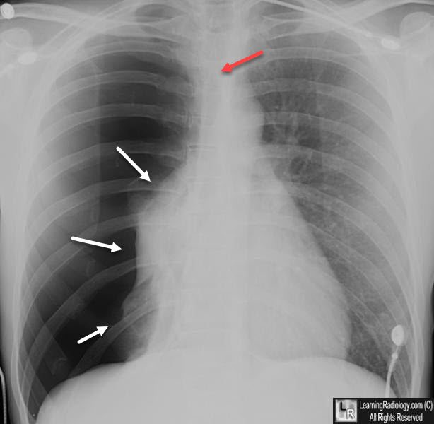 LearningRadiology - Tension, Pneumothorax, ptx, spontaneous