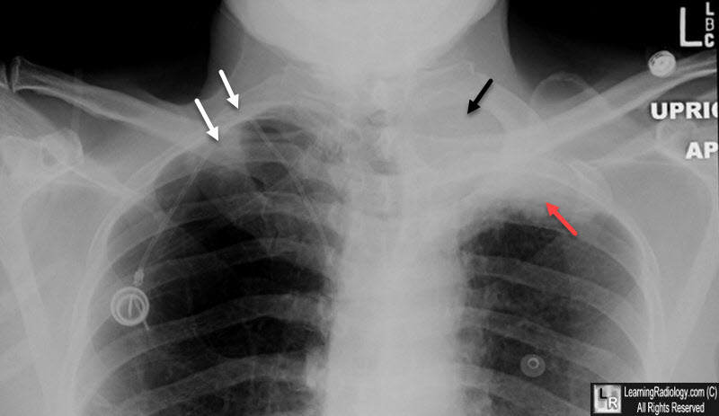 Superior Sulcus Of Lung