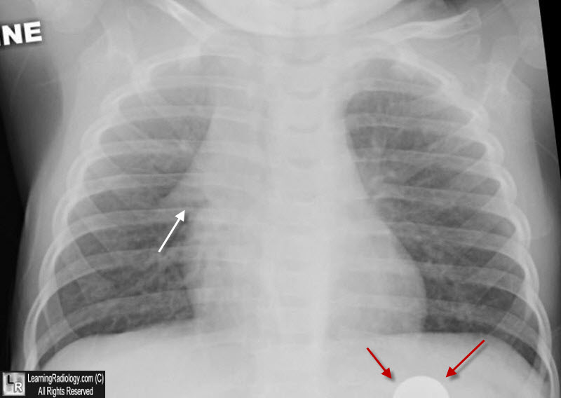 Learning Radiology - Coin in Stomach