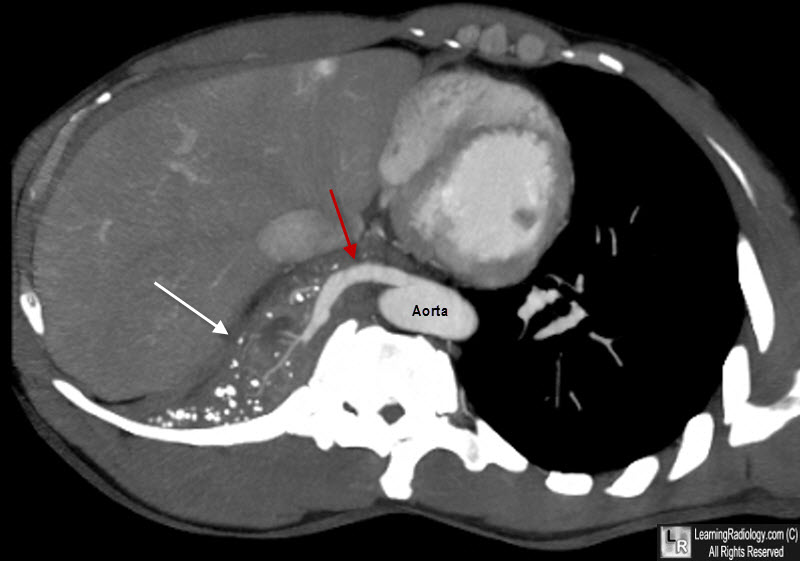 Learning Radiology - Bronchopulmonary Sequestration