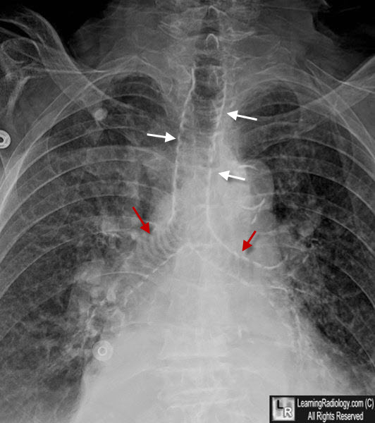 Learning Radiology - Calcification of the Tracheal Rings