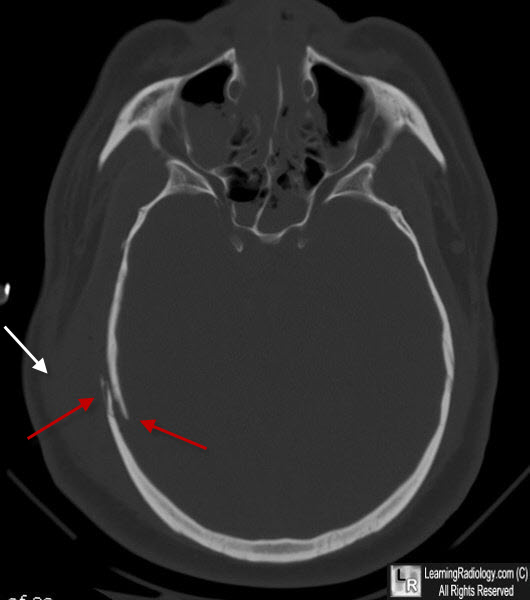 Learning Radiology - Depressed Skull Fracture