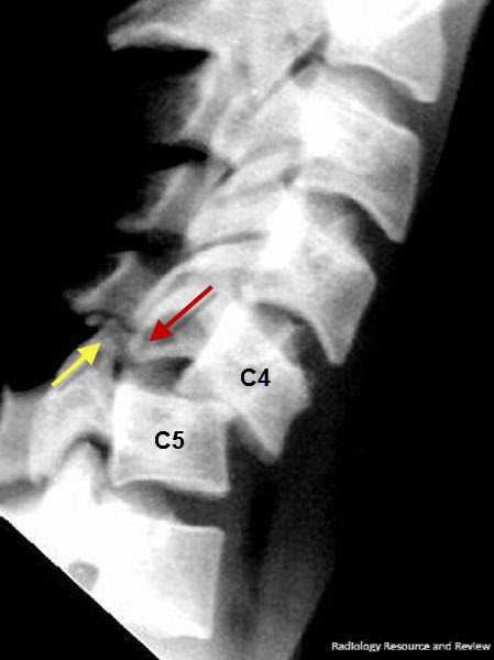 Learning Radiology - locked, facet, facets, locked, facets, bilateral ...