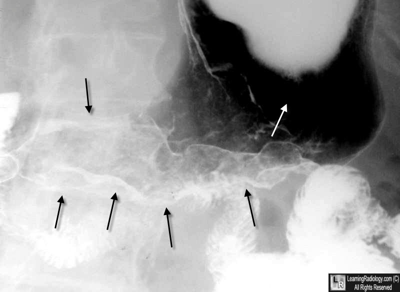 LearningRadiology - Carcinoma of the Stomach
