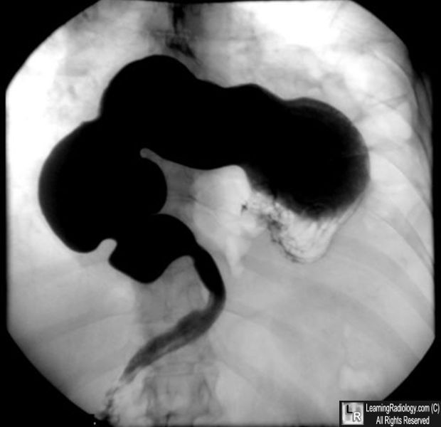 LearningRadiology - Gastric Volvulus, Organoaxial, Mesenteroaxial