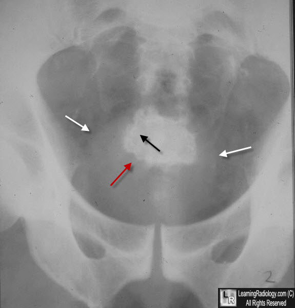 Learning Radiology - Bladder, calculi, stone, calculus, jackstone