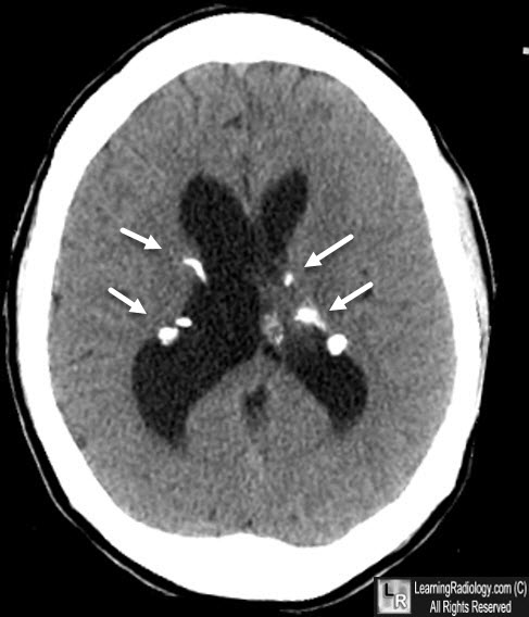 LearningRadiology - Tuberous Sclerosis
