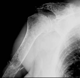 LearningRadiology-Bone Tumors